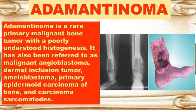 Adamantinoma 1