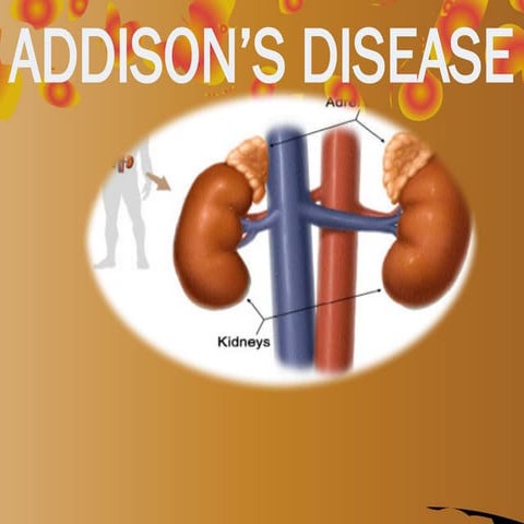 Addison Disease Addison Disease (Hypoadrenocorticism) Wellness