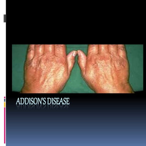 Addison’s disease | PPTX
