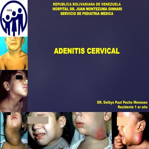 Adenitis Cervical | PPTX