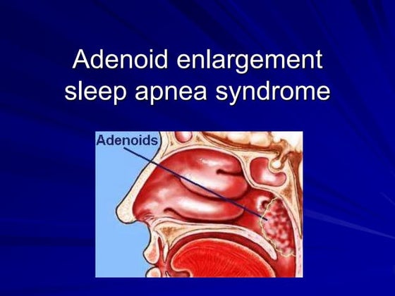 Adenoids Hypertrophy | PPT