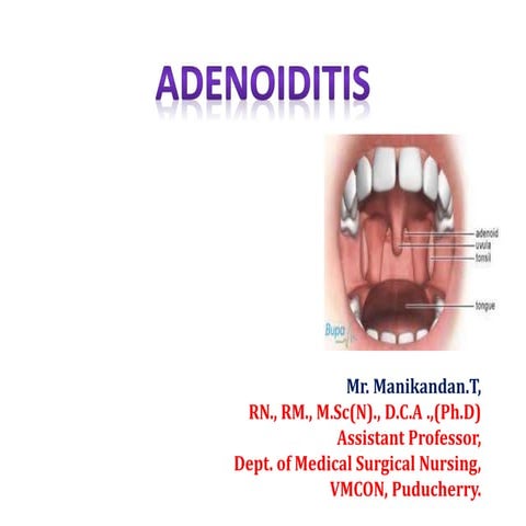 Adenoiditis | PPTX | Ear, Nose and Throat Conditions | Diseases and ...