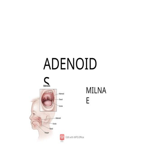 ADENOIDS-WPS Office(1).pptx ent ppt adenoids | PPTX