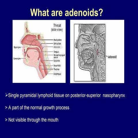 Adenoids Hypertrophy | PPT