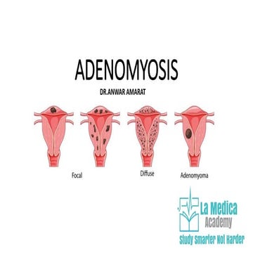 Adenomyosis .pdfhihhihihininijkjojjojojojojo | PDF