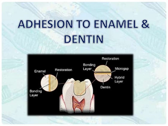 Acid Etching of Enamel and Bond Strength | PPT