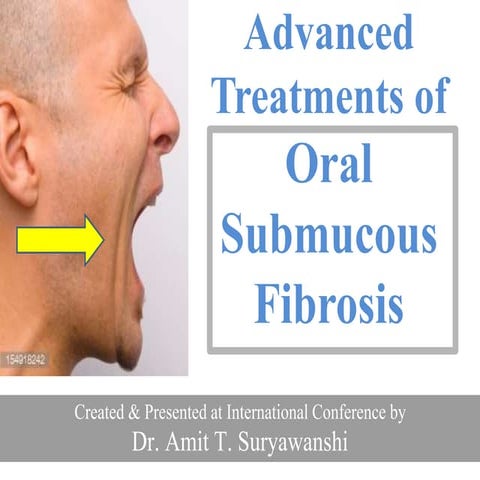 Advanced Treatment of Oral Submucous Fibrosis by Dr. Amit | PPTX