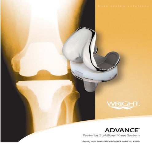 Advance® posterior stabilized knee system | PDF