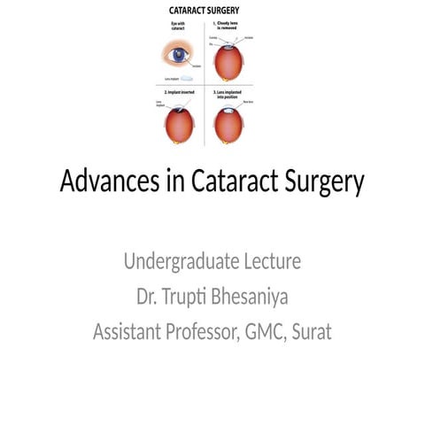 Advances_in_Cataract_Surgery_Undergraduate_Lecture.pptx