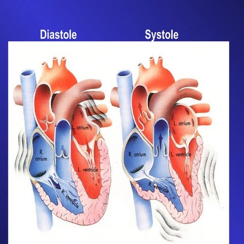 overview on cardioplegia by Dr. Idit Avrahami | PPT