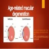 Age related macular degeneratio | PPTX