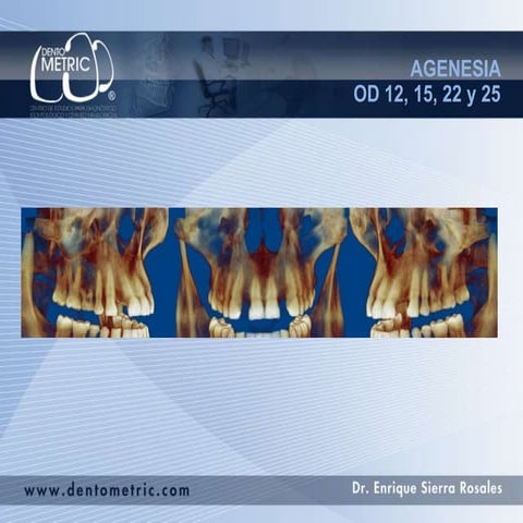 Agenesia od 12 y 22 | PPTX