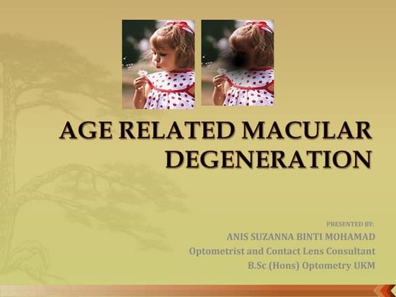 Age related macular degeneration | PPTX