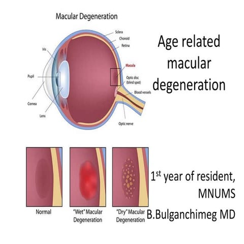 Age related macular degeneration | PPTX