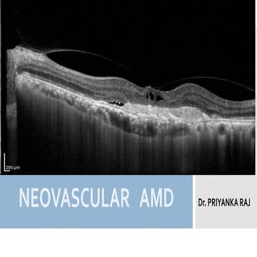 Choroidal neovascular membranes (CNVM) | PPTX