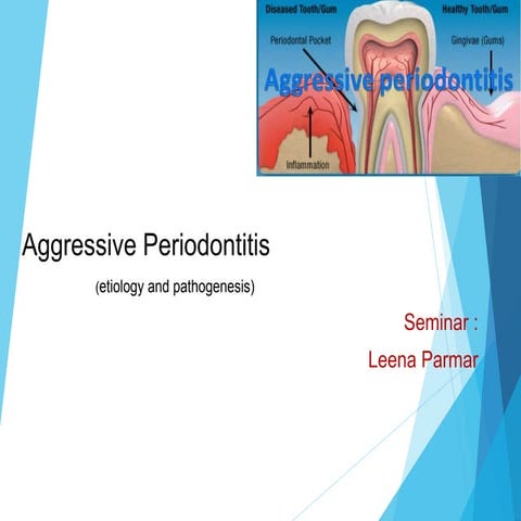 Aggressive periodontitis ul | PPT