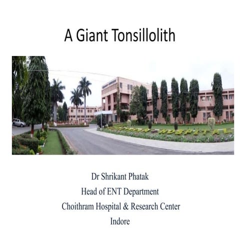 A giant tonsillolith | PPTX