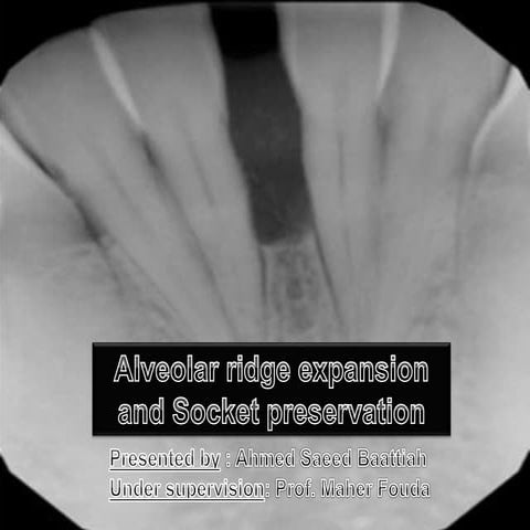 alveolar ridge expansion and socket preservation | PPT | Bone and Joint ...