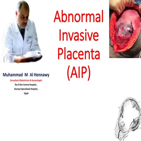Abnormal Invasive Placenta | PPTX