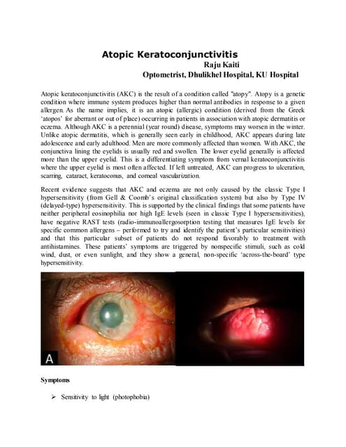 Ocular allergy | PPTX | Eye and Vision Conditions | Diseases and Conditions