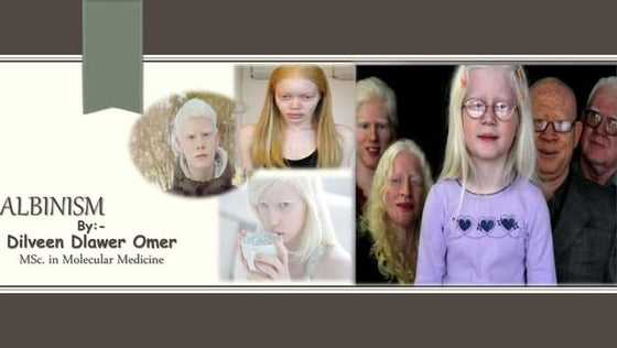 Albinism powerpoint[1] | PPT | Eye and Vision Conditions | Diseases and ...
