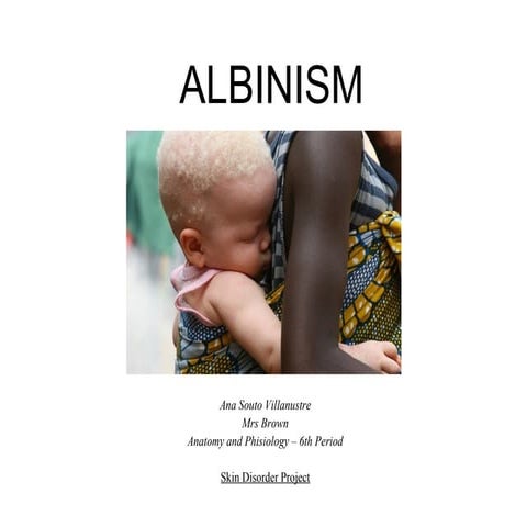 Albinism | PPT