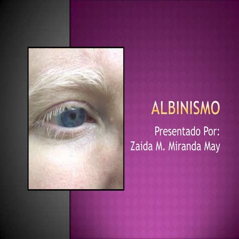 Albinismo | PPTX