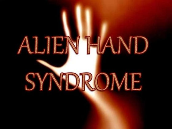 Pericallosal Artery Infarction & Alien Hand Syndrome | PPT
