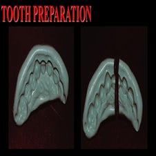 Tooth Preparation - All ceramic crowns | PDF
