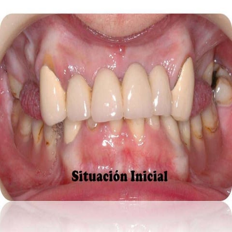 Acellular dermal allograft. Soft tissue augmentation. | PPT