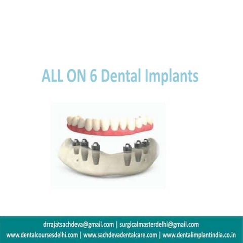 All on 6 dental implants | PPTX