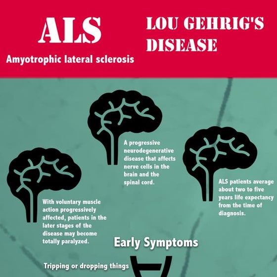 [INFOGRAPHIC] Fighting ALS – From the Beginning | PDF | Physical ...