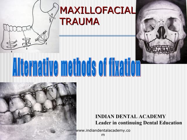 Dento Alveolar Fractures | PPT