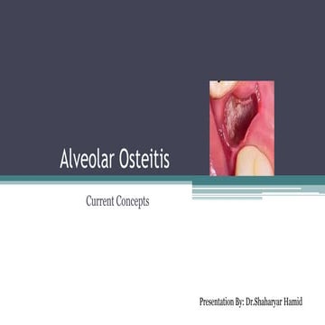 Alveolar osteitis - DIKIOHS DUHS | PPTX