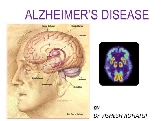 RECENT ADVANCES IN ALZHEIMER'S DISEASE | PPTX | Brain and Nervous ...