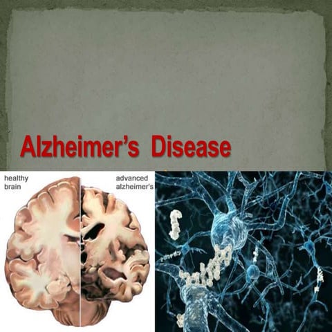 Alzheimer's disease | PPT