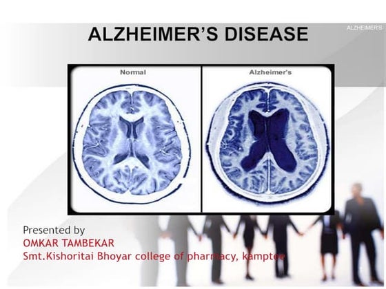 Alzheimer's disease - A detailed case study | PDF