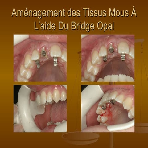 Gingival Improvement through Removable Bridge | PPT
