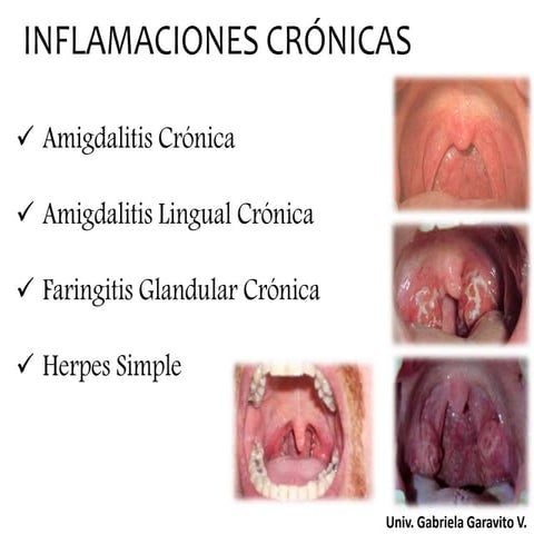 AMIGDALITIS CRONICA UNIVERSIDAD DEL ZULIA | PPTX | Ear, Nose and Throat ...