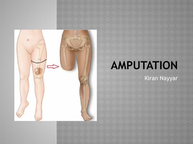 Principles of amputation | PPTX