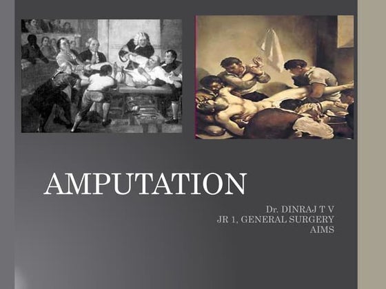 Amputation Orthopaedics | PPT