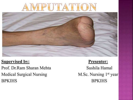 Amputation | PPTX