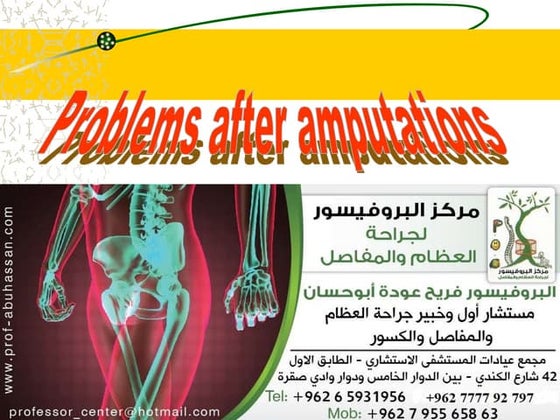 Butler's procedure overriding 5th toe - البروفيسور فريح عوده ابوحسان | PPT