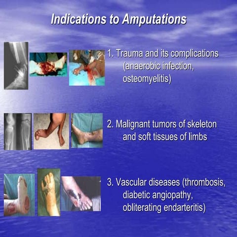 Amputations and disarticulations in limbs.ppt