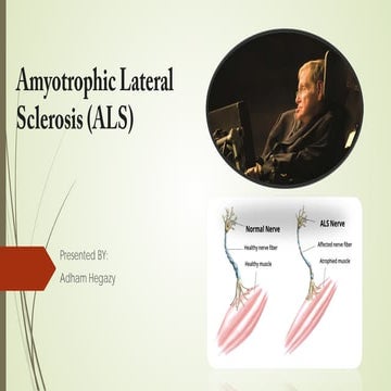 Amyotrophic lateral-sclerosis-als- | PPT