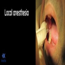Local anesthesia in dentistry and types.pptx