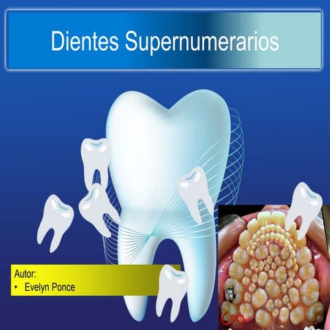 Dientes supernumerarios | PPTX
