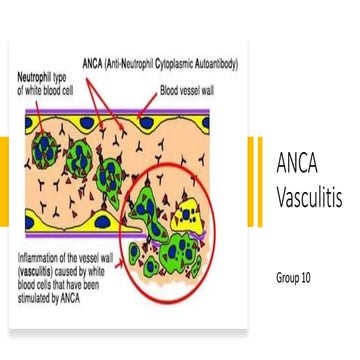 ANCA Vasculitis (2).pptx
