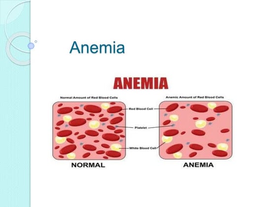 Anaemia- Classification, types, causes, pathophysiology, etiology | PPT