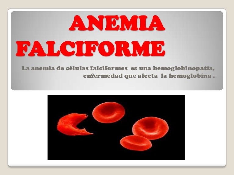 Anemia Falciforme